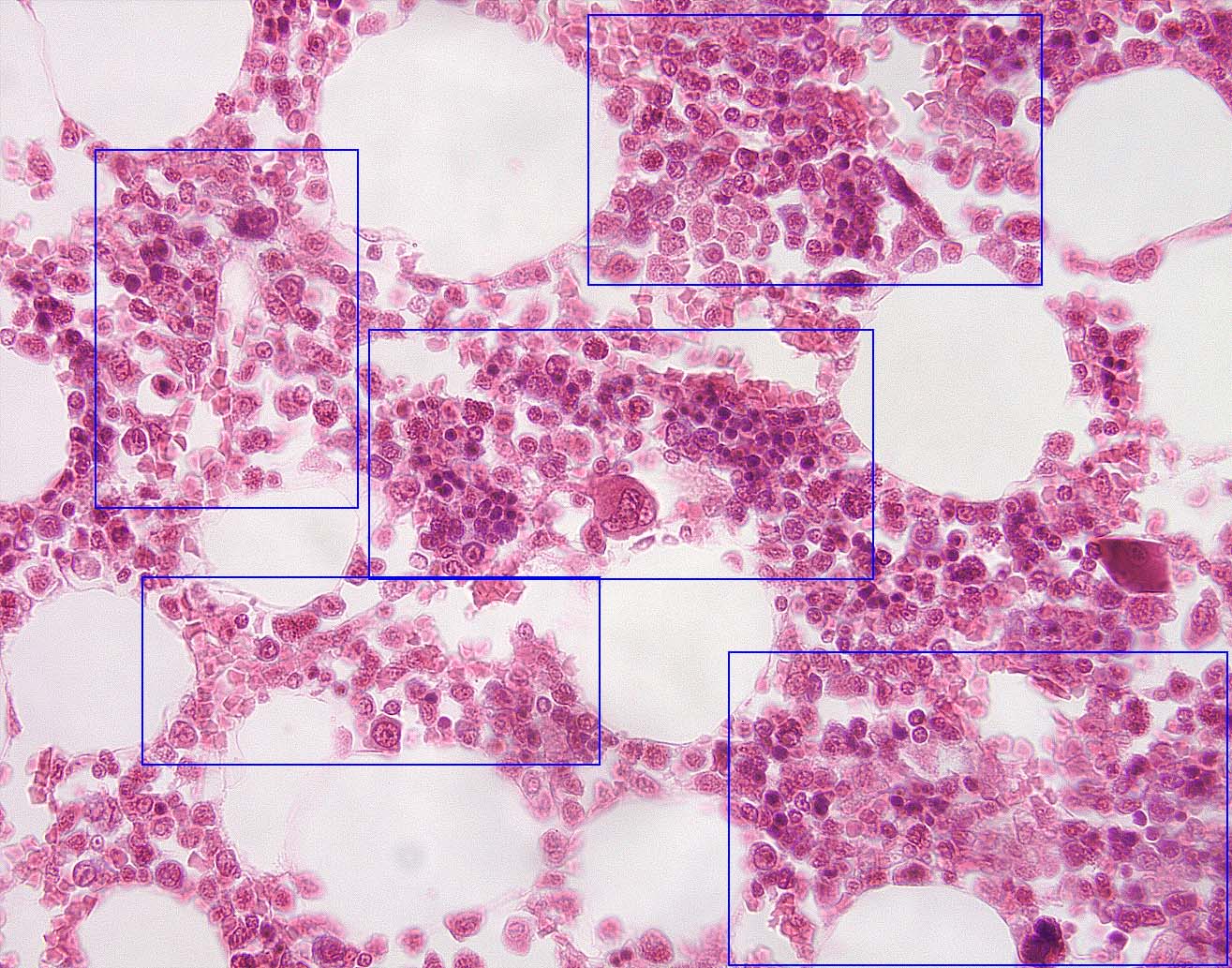 Bone Marrow with Megakaryotcyte at 400X Magnification