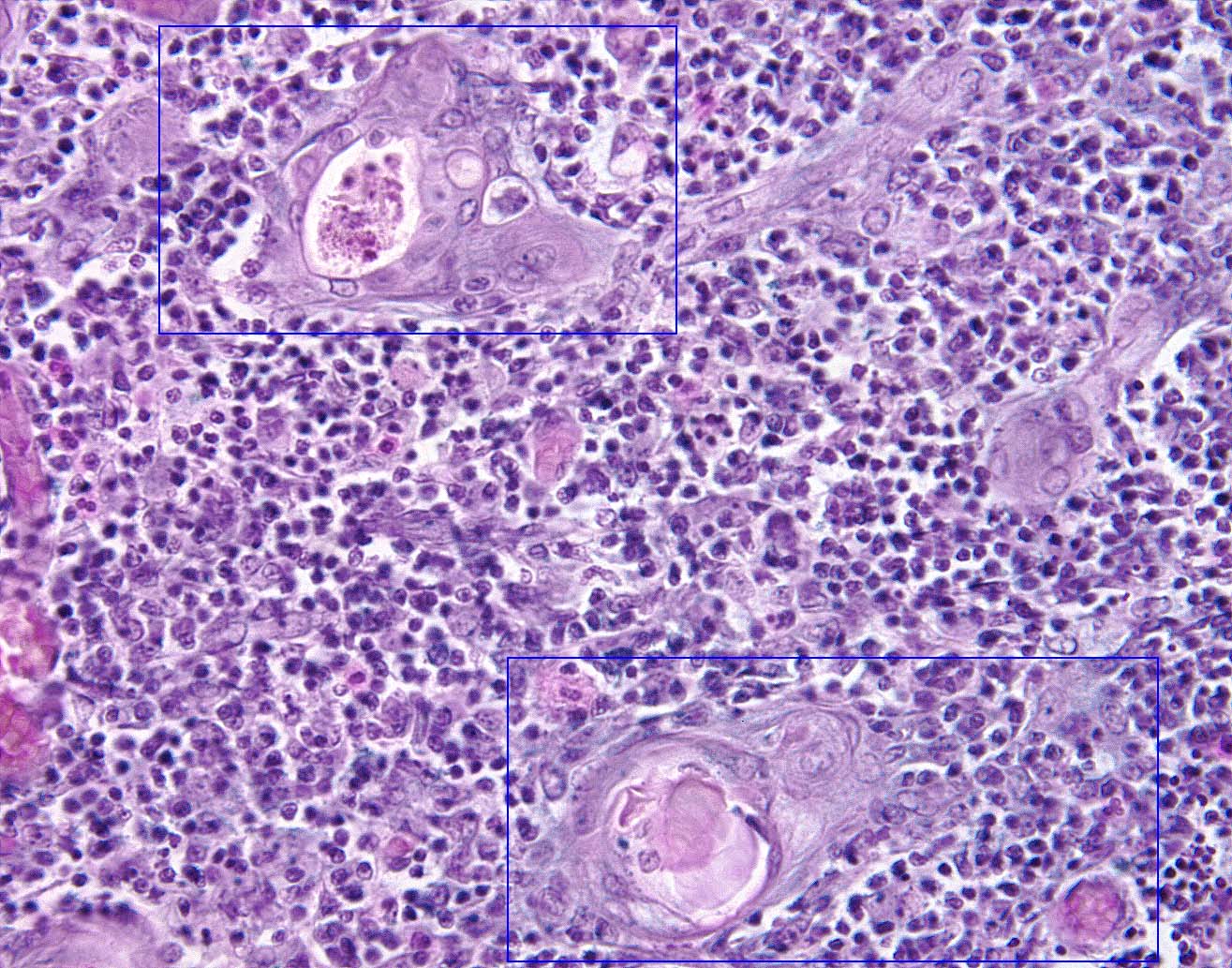 Hassall's Corpuscle of Thymus at 400X Magnification
